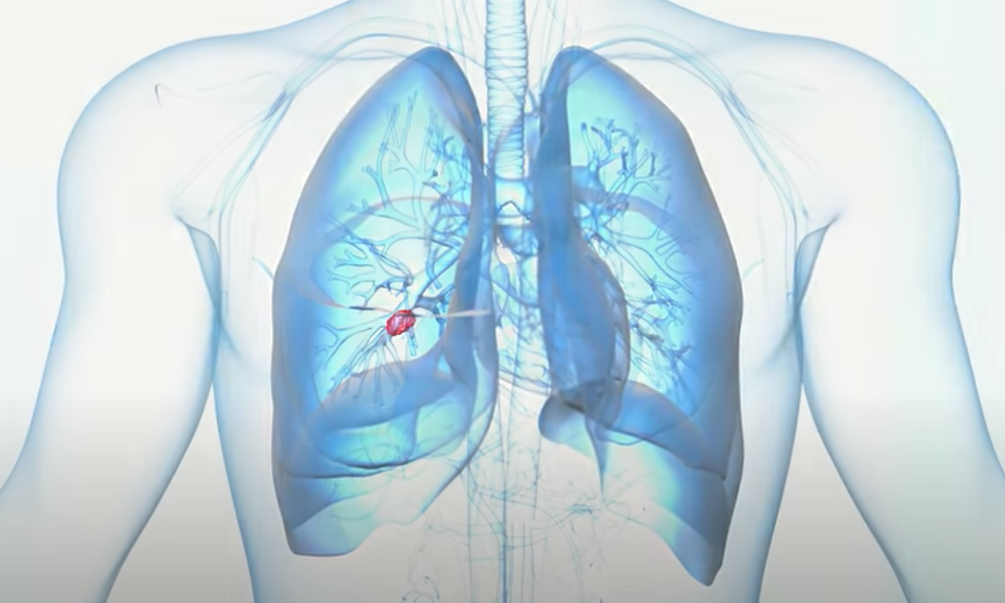 Resources - CyberKnife®